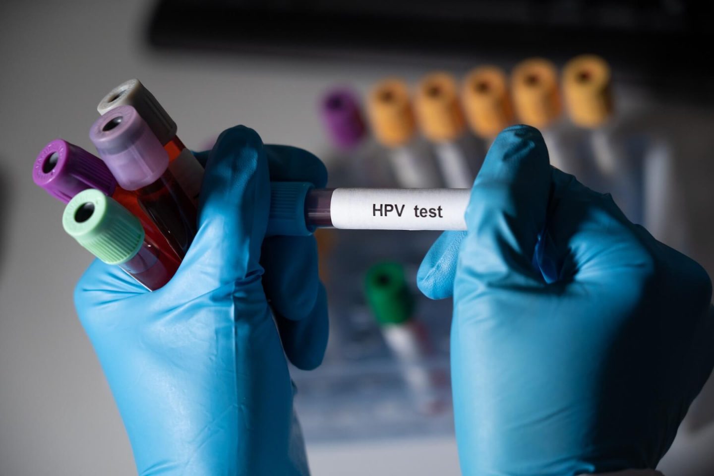 Condylome : ne restez pas assis sur vos verrues génitales